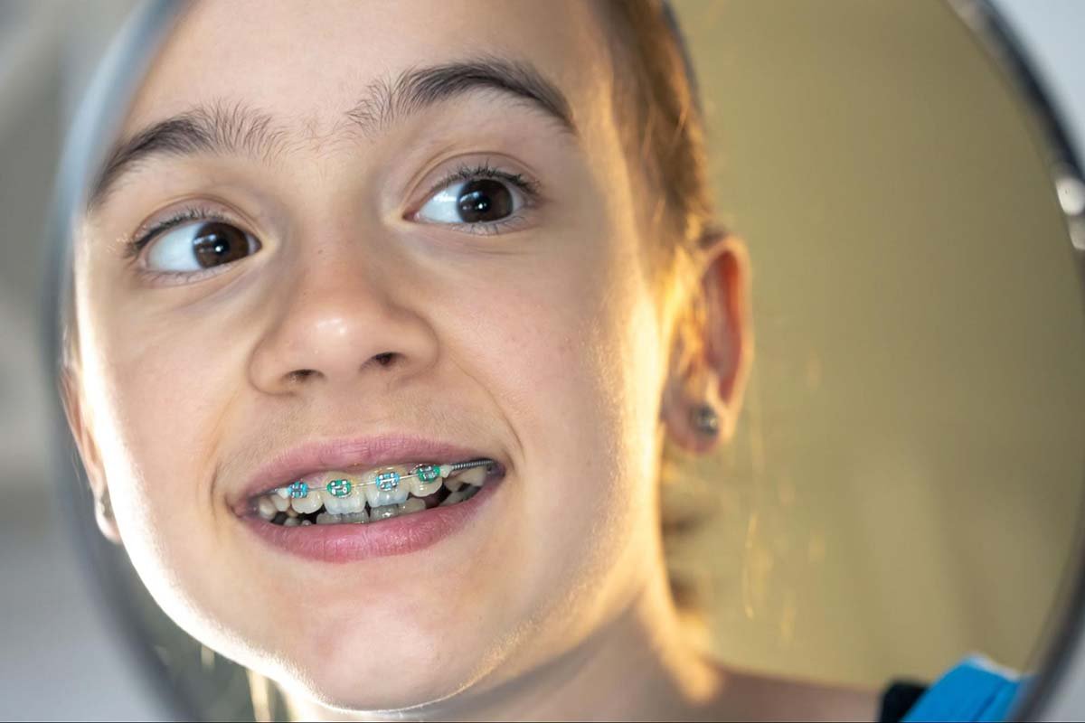 How Much Do Braces Cost for Children? Full Breakdown